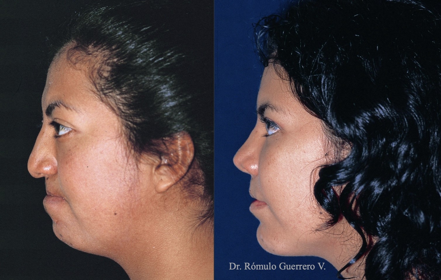 Cirugía Ortognática – Dr. Romulo Guerrero